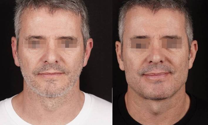 Prótesis ángulo mandibular - Clínica Birbe
